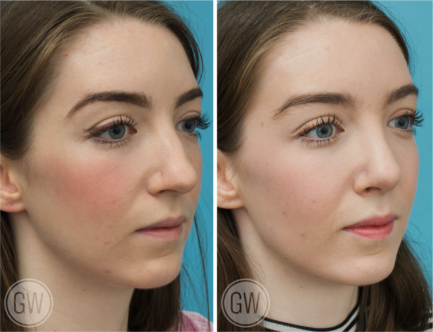 Top 5 ways to Improve Your Nose - 5 Popular Nose Job Procedures