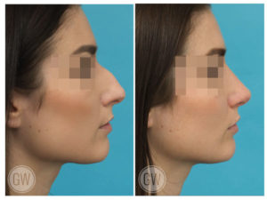 What is a Dorsal Hump? - Dr. Guy Watts