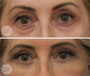 Hooded Upper Eyelids: Understanding the Causes and Treatment
