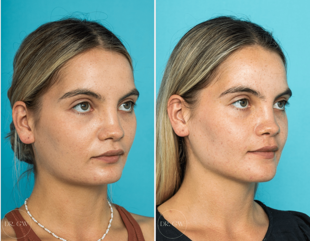 What Is Jaw Augmentation? - Dr. Guy Watts