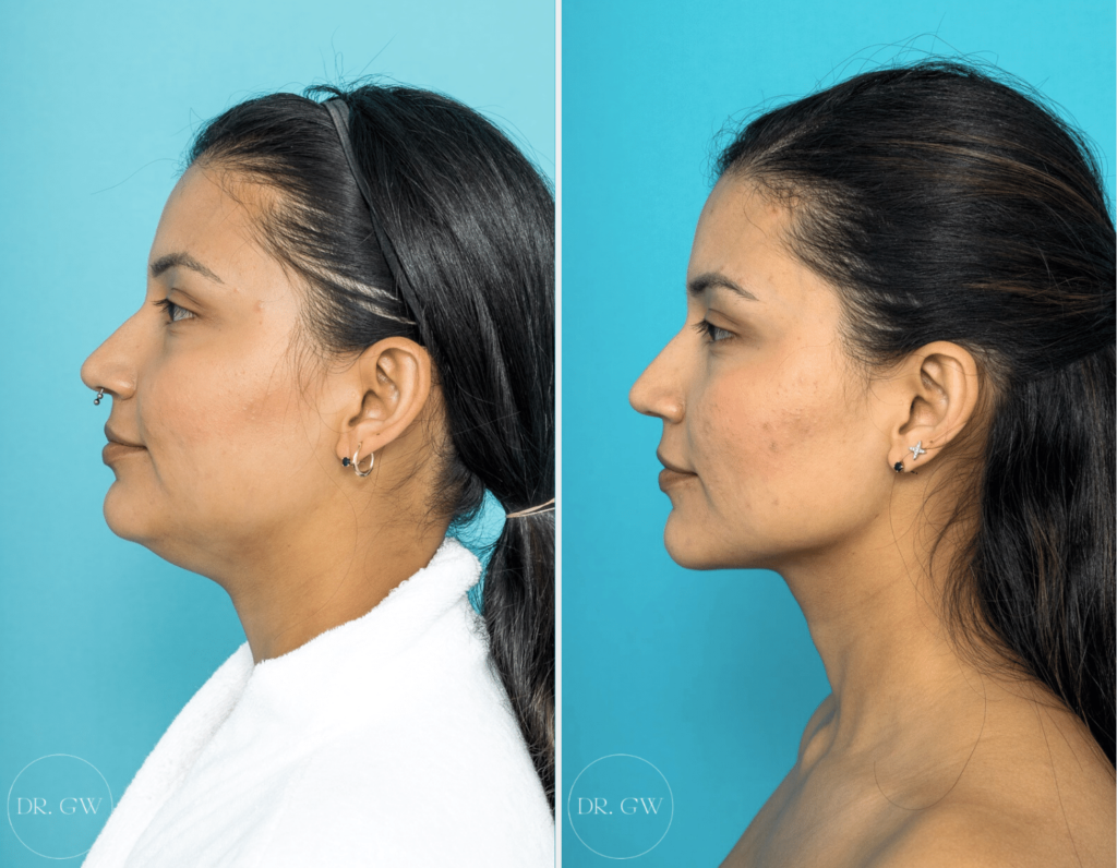 What Is Chin Ptosis? - Options for Double Chin Treatment - Dr. Guy Watts