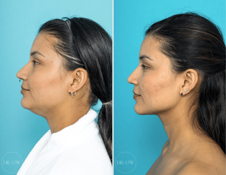 What Is Chin Ptosis? - Options for Double Chin Treatment - Dr. Guy Watts