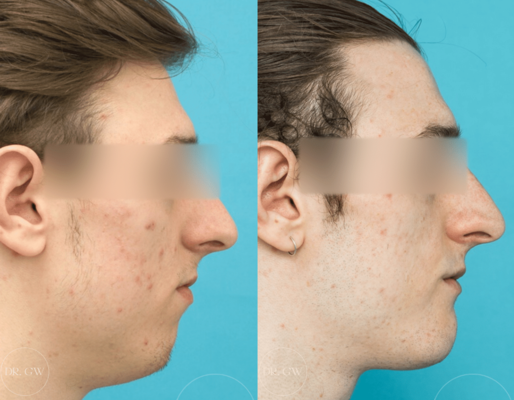 Receding Chin – What Is It, Causes and Options | Dr Guy Watts