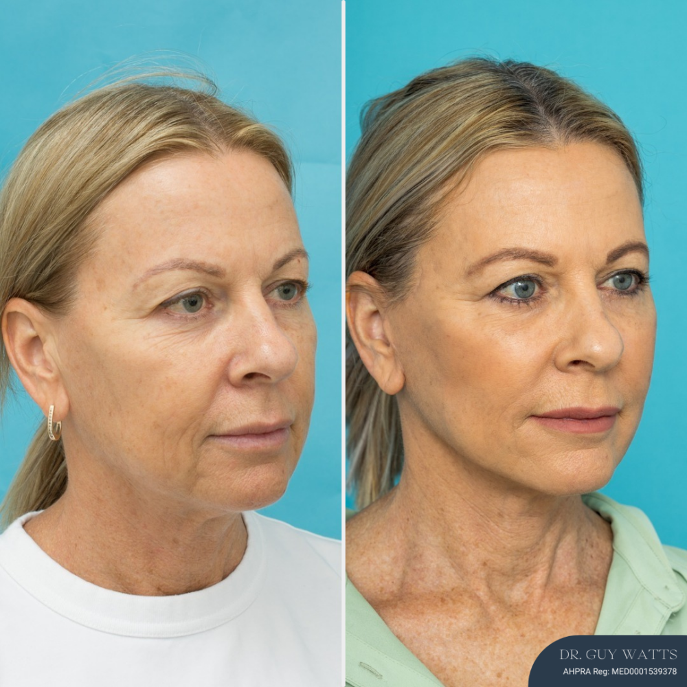 Blepharoplasty Scars: Healing & Management Guide |Dr Guy Watts